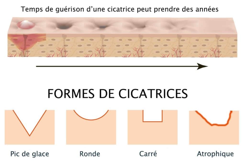 TRAITEMENT DES CICATRICES - ARTHESTIC