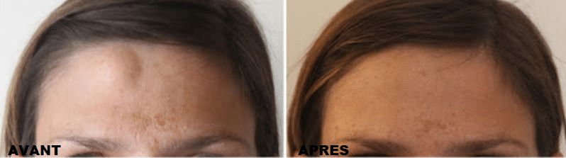 Chirurgie dermatologique des lipomes - ARTHESTIC