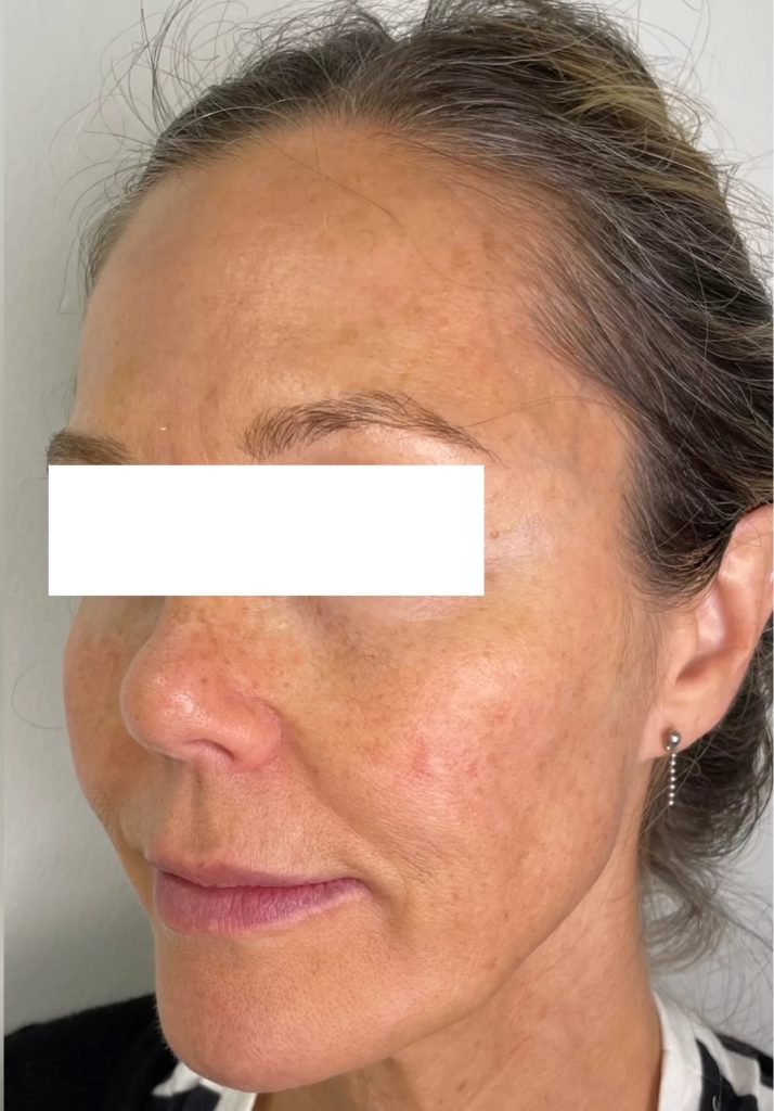 Injections d'Harmonyca® - ARTHESTIC