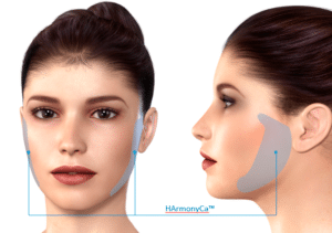 Injection d'HARMONYCA - ARTHESTIC